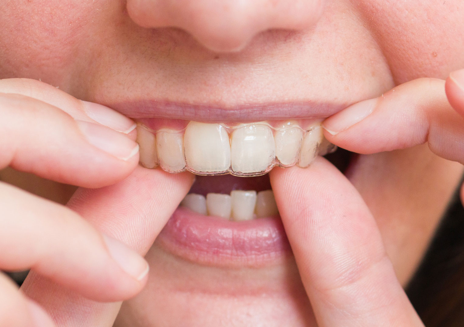 Is Invisalign noticeable? - Dream Smiles Dental
